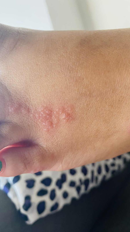 Rashes sa Paa Hi mga mima, may nakaexperience ba dito ng mga