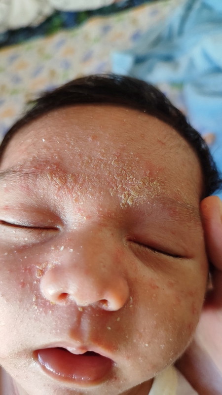 Baby Acne Hi mommies. First time mom here. Currently 3weeks