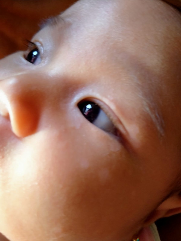 White Spot sa muka ni baby White spot sa mukani baby ano po