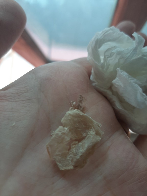 Puting sobek dan keluar cairan Mom, disini ada rekomendasi u