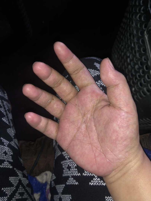 Manhid sa kamay Hello nga mommies ask ko lng kung normal lan