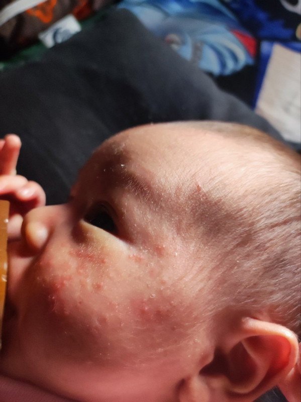 Ano po ito mga butlig sa mukha ni baby normal ba Paano po ka