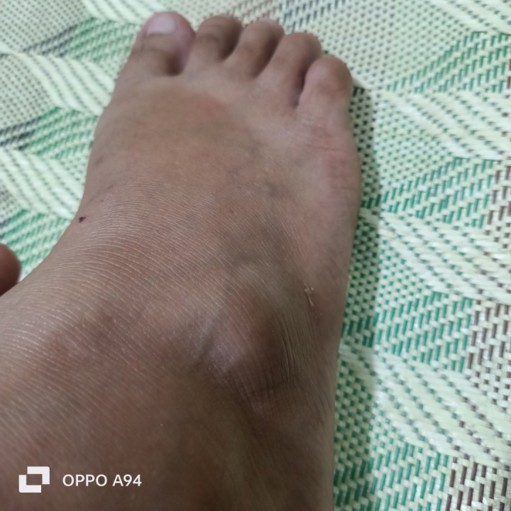 Nadulas ako, ano kaya pwede mangyari sa paa ko na namamaga n