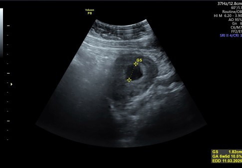 Kehamilan 7 Minggu 4 hari tapi pas di USG 6 Minggu 5 hari ad