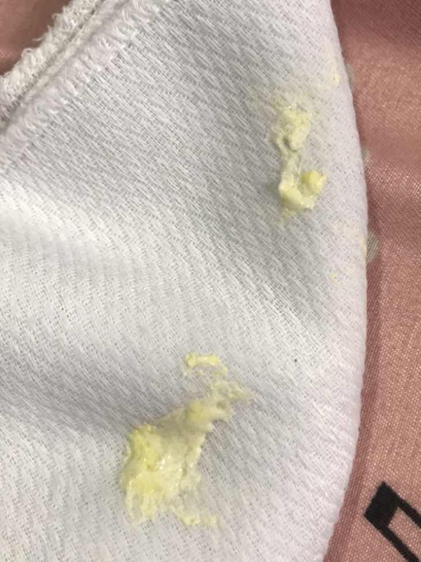 color yellow plema? plema po ba ito kasama po sa lungad ng b