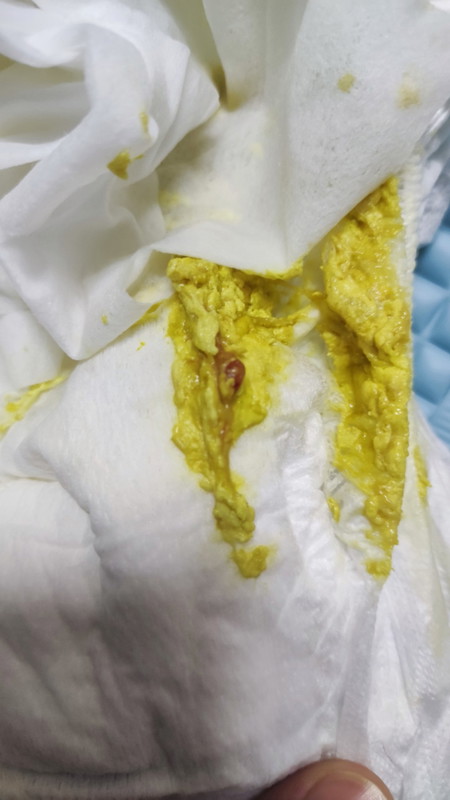 Baby berak lendir + darah Hi, baby baru sebulan 1 hari. Hari