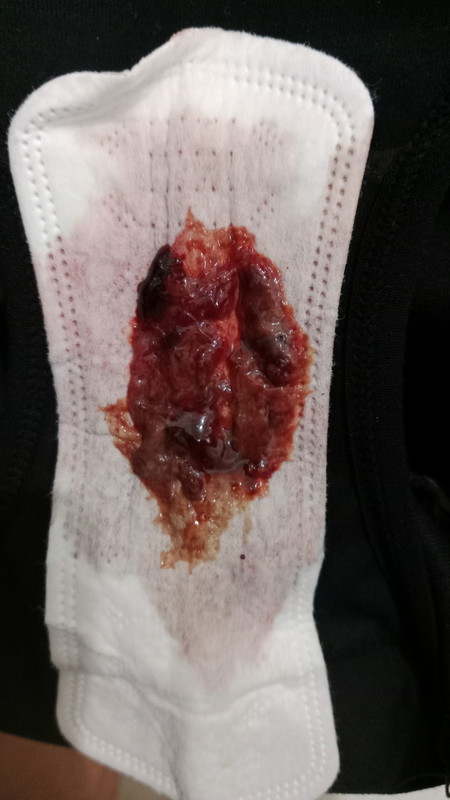 Normal po ba sa 3 weeks na nanganak ang ganito? Regla na po