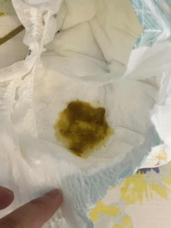 Mucus in baby’s poop May mga nakaranas na po ba sa inyo na n