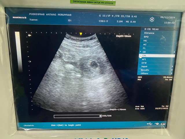 Usia Kandungan HPHT 26 Oktober 2024, tp saat USG tgl 6 Des 2
