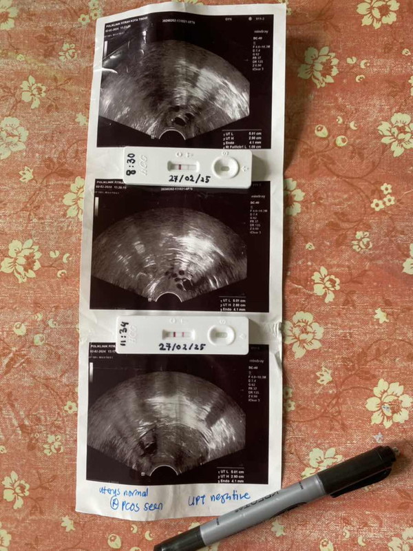 Hi, I am a PCOS Fighter. Period delay almost 2 months, Test