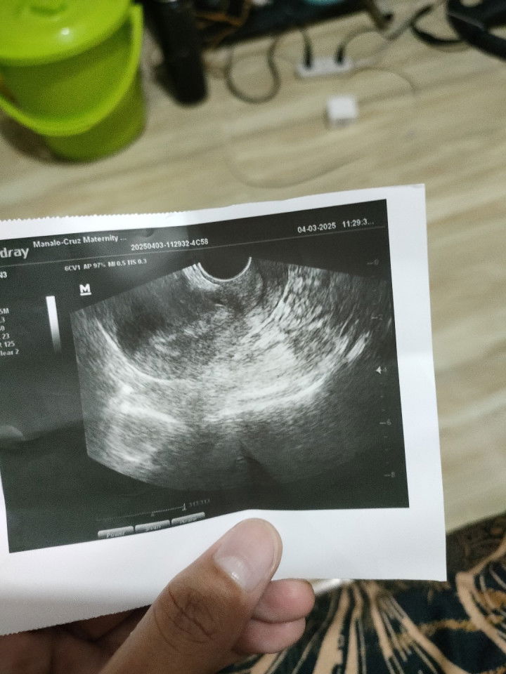 Positive sa PT pero sa TVS walang laman na baby. Early pregn