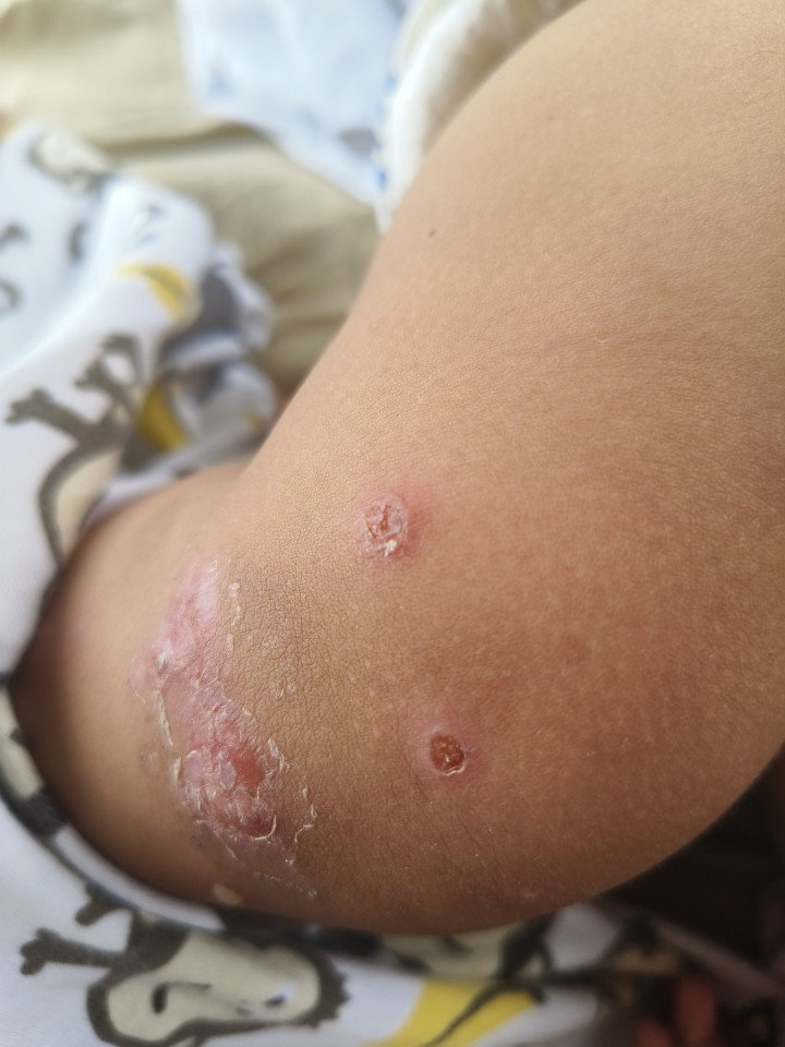 Nagtutubig yung kagat ng langgam at lamok Ano kaya ang over