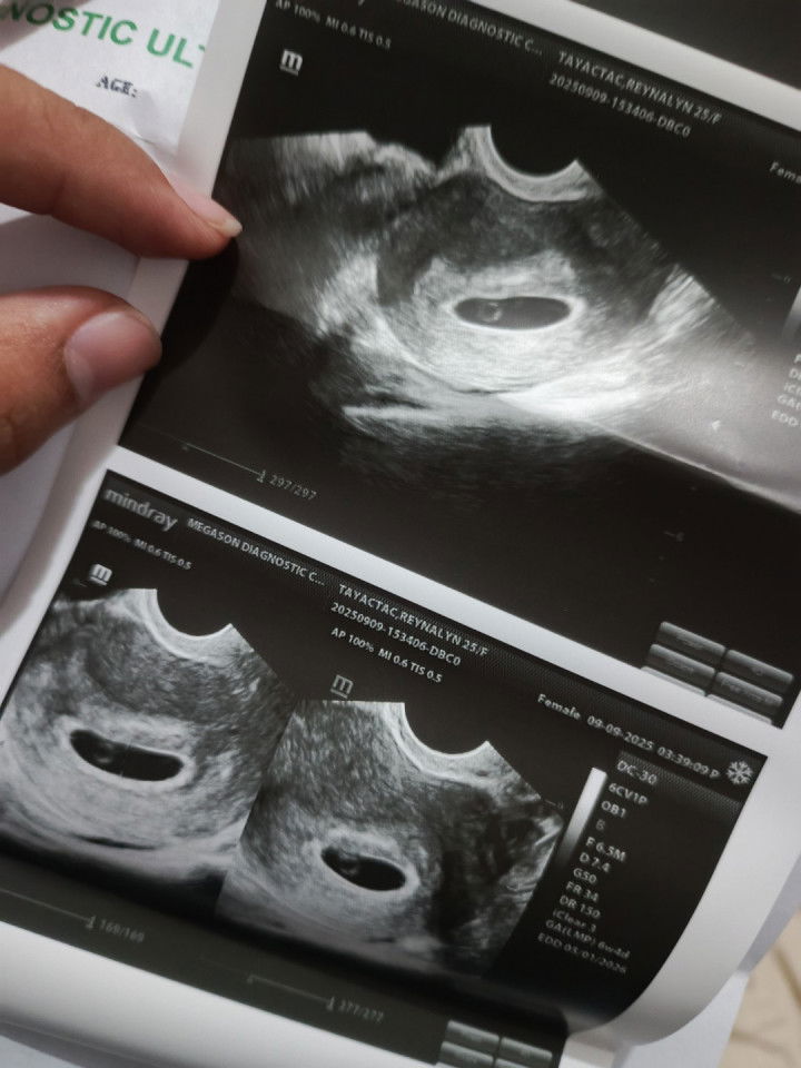 5 weeks and 6days May yolk sac but no fetal pole. Ano po mea