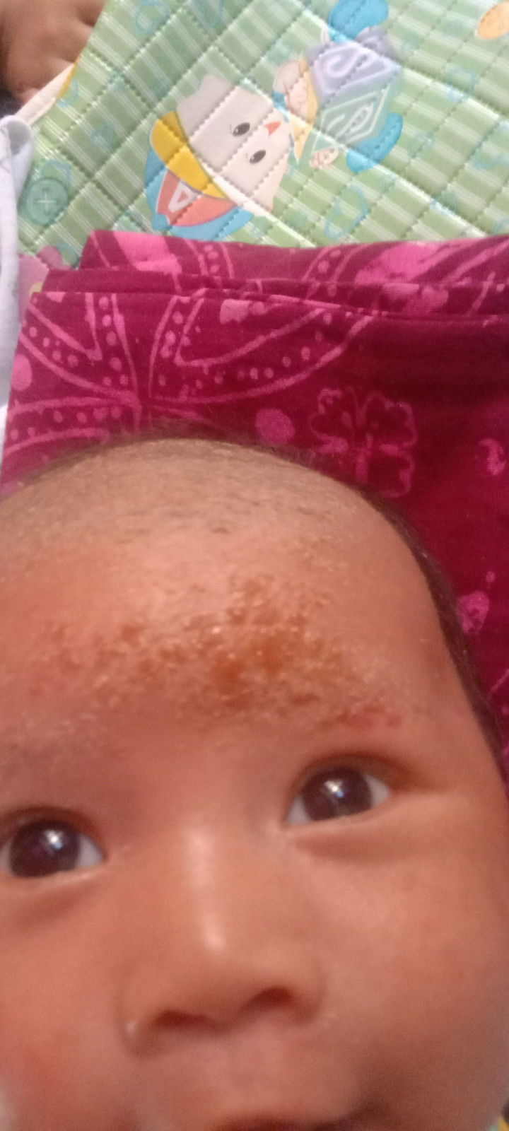 Kerak sampe ke dahi Ada yang sama nggak sih kerak kepala sam