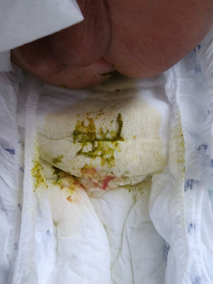 Najis berdarah Hi, anak saya najis berdarah. 3months. Dia se