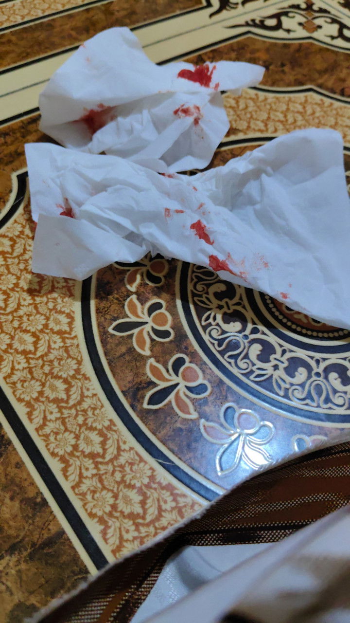 Mimisan saat hamil Disini ada ga bunda yang hamil tapi serin