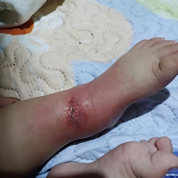 Insect bites Ano po kaya ito mga mi? Una pra tusok n maliit