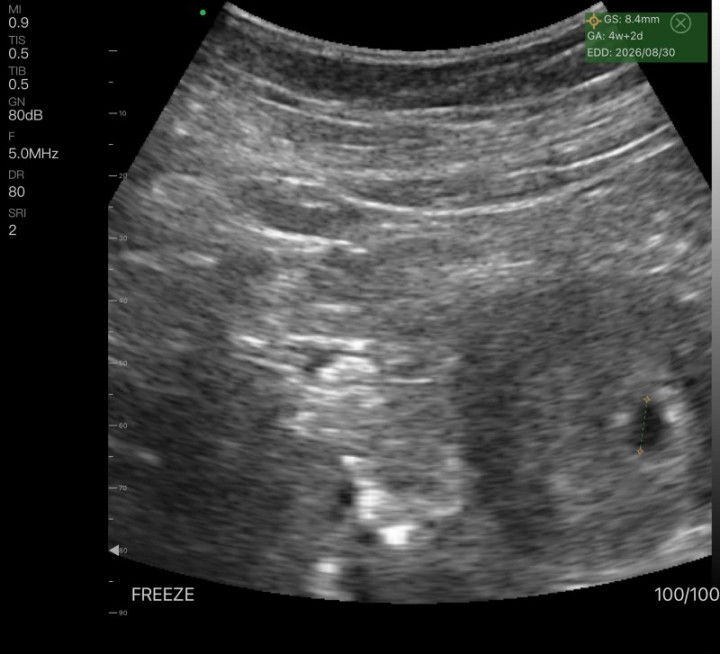 Gestational Sac Only Normal pa ba to sa Age ni baby? Last me