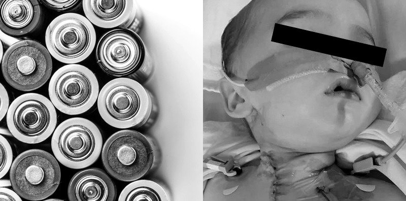 Baby swallowed battery and becomes permanently disabled!