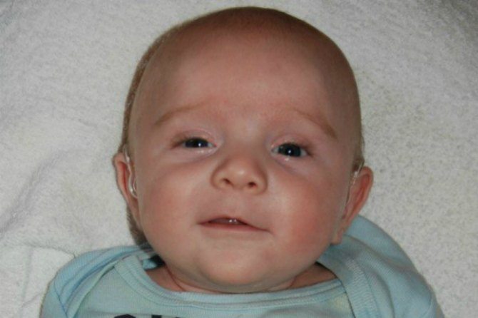 Common Virus with No Symptoms Left Baby Disabled for Life