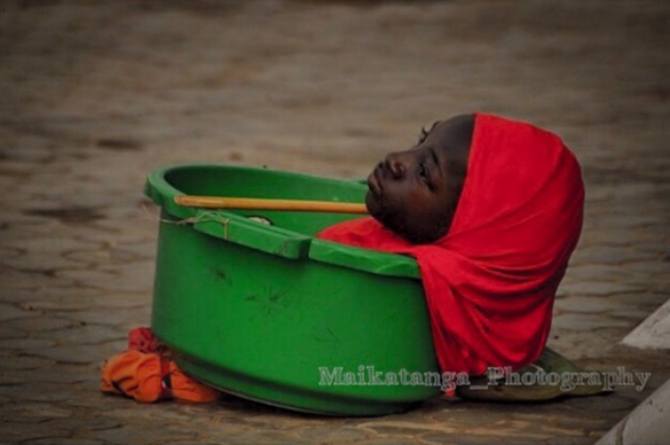 Limbless Teen Who Lived In A Plastic Bowl Has Passed Away