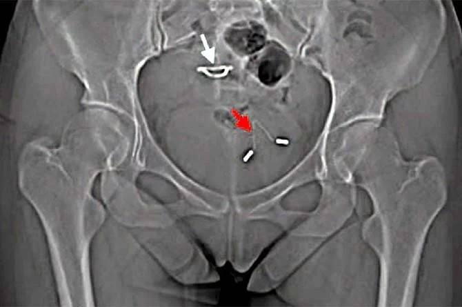 IUD dangers: Woman Suffers From Punctured Uterus And IUD In Bladder