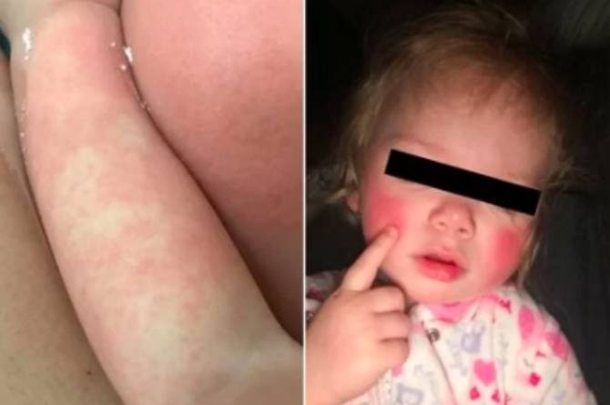 A Rare Condition Makes This Minnesota Toddler Allergic To Water