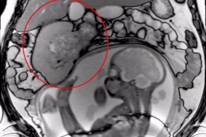 Tumor In Pregnancy: Mother Credits Son For Saving Her From Cancer