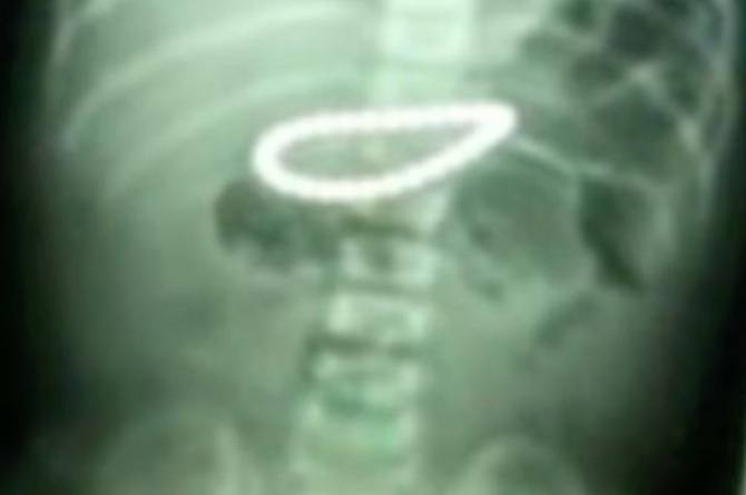 Dangers of Magnetic Toys: Toddler Swallows 21 Magnetic Beads