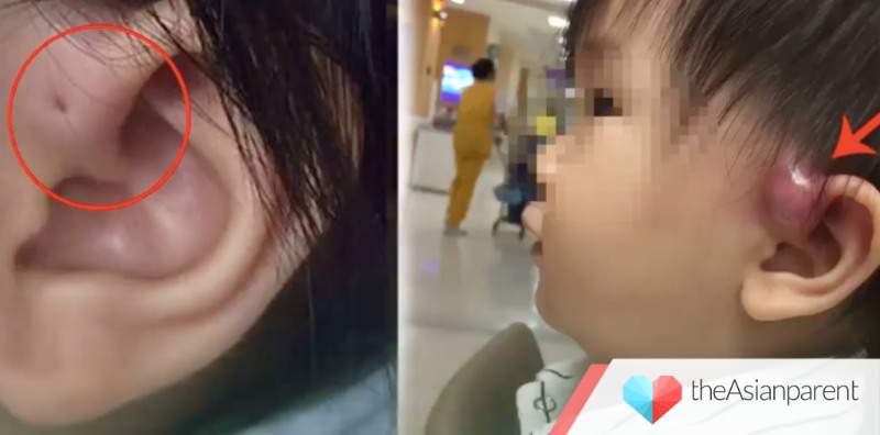 Butas sa tenga naging sanhi ng malalang impeksyon ng isang bata