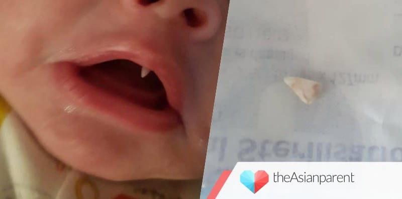 Baby Teeth Growth: 11-Week-Old Baby Grows Fang Overnight