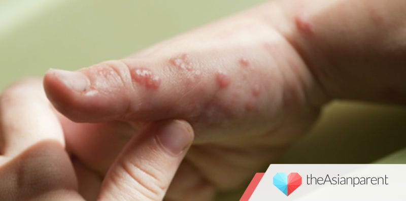 Ischemic stroke: Isang uri ng stroke na nagmumula sa bulutong