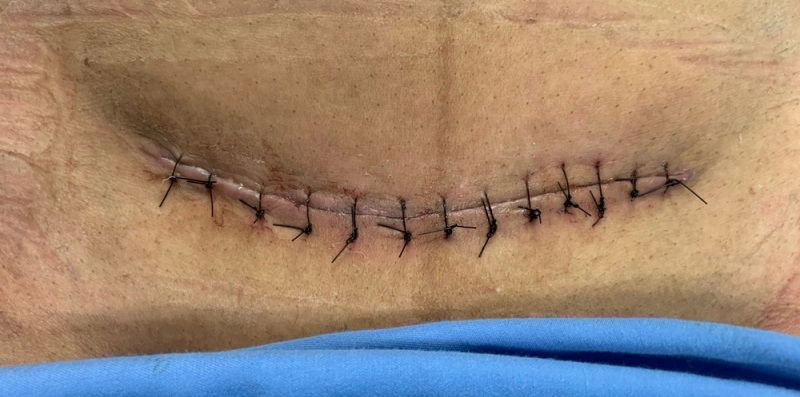 Caesarean Section Wounds: How To Take Care Of Your CS Wound