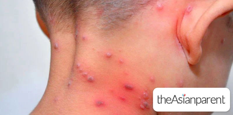 Gamot Sa Peklat Ng Bulutong: Paraan Para Mawala Ito