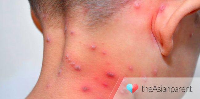 Gamot Sa Peklat Ng Bulutong: Ano Ang Pinakamabisa Para Mawala Ito?