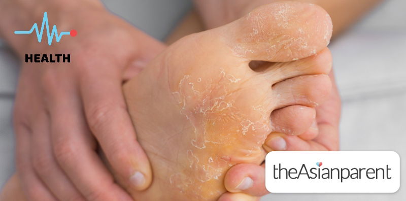 Alipunga Sa Paa: Sanhi, Sintomas, Home Remedy, At Gamot Para Rito