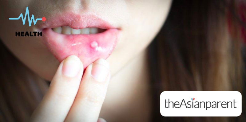 Cause Of Singaw: Symptoms, Medicine, And Prevention Of Mouth Ulcers