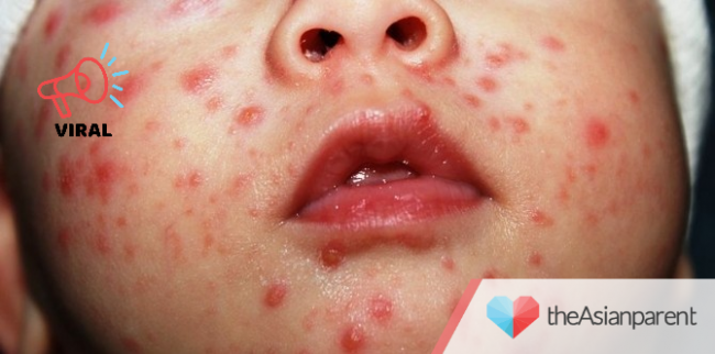 Komplikasyon ng bulutong, muntik nang ikamatay ng baby