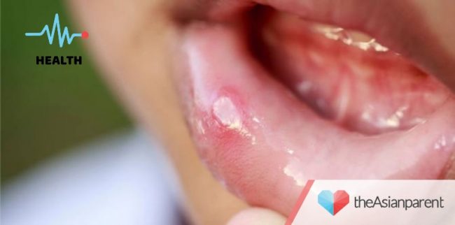 Canker Sores: Causes, Symptoms & Treatments For Singaw