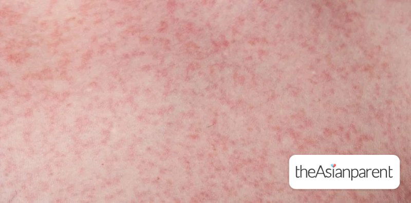 Dengue Rashes: Ano Ang Pagkakaiba Nito Sa Allergy Rashes