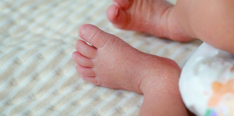 Scalded Skin Syndrome, Baby Nabulok Ang Daliri Dahil Sa Sakit Na Ito