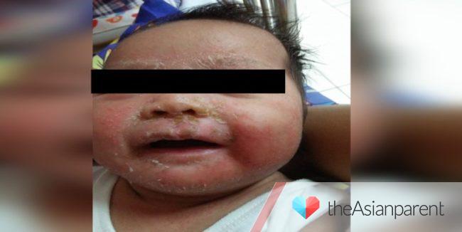 Scalded Skin Syndrome Contagious? More Info About the Disease Here