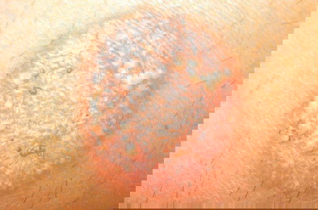 Larawan ng Iba't Ibang Uri ng Sakit sa Balat at Gamot Sa Mga Ito