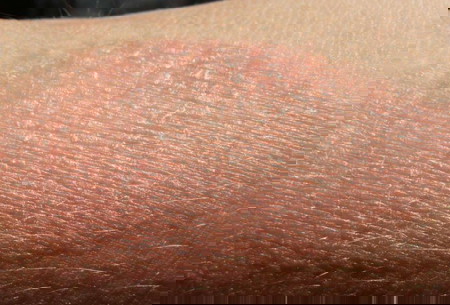 Larawan ng Iba't Ibang Uri ng Sakit sa Balat at Gamot Sa Mga Ito