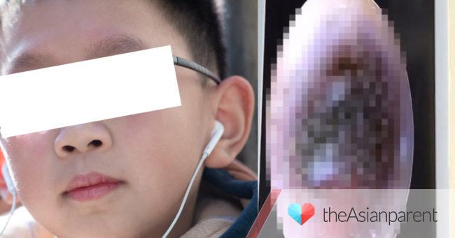 Bata, Nagkaroon Ng Amag Sa Tenga Dahil Sa Pagsusuot Ng Earphone