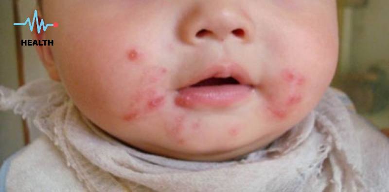 Gamot Sa Mamaso Sa Bata At Matanda At Paraan Para Maiiwasan Ito