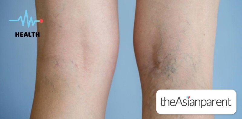 Ano Ang Varicose Veins Ng Buntis? Alamin Kung Paano Ito Matatanggal
