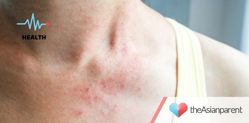 Gamot sa Bungang Araw: Top Na Mga Produkto Para sa Prickly Heat