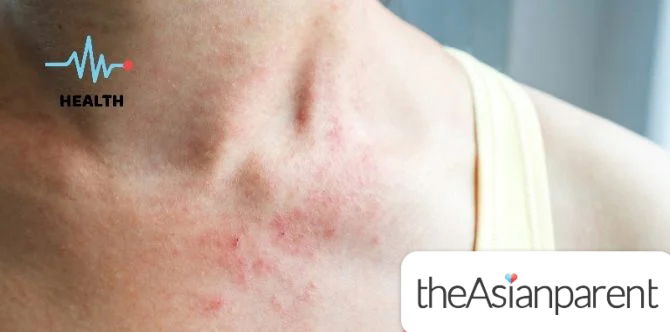 Gamot sa Bungang Araw: Top Na Mga Produkto Para sa Prickly Heat