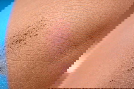 First Aid Para Sa Sugat? Ito Ang Sagot At Payo Ng Isang Doktor